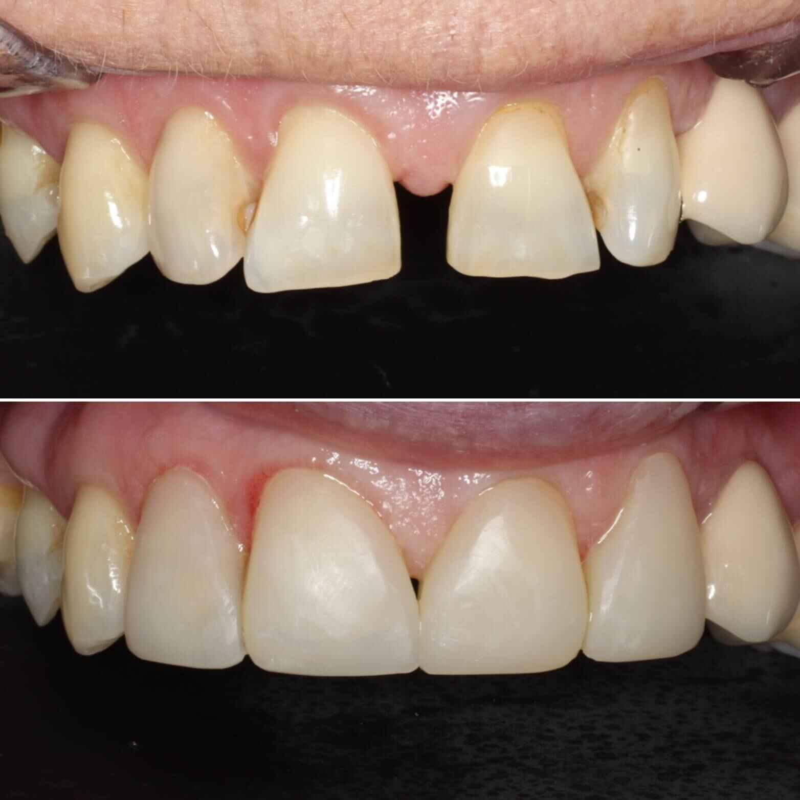 Patient Results - AllCare Beenleigh Dental