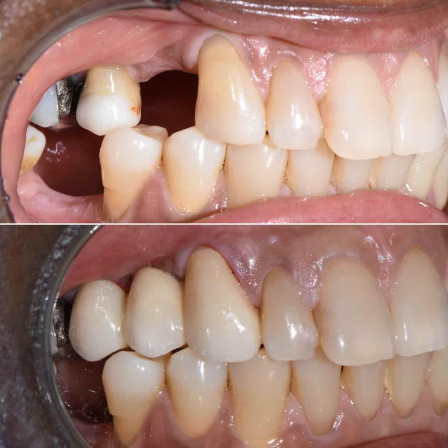 Patient Results - AllCare Beenleigh Dental